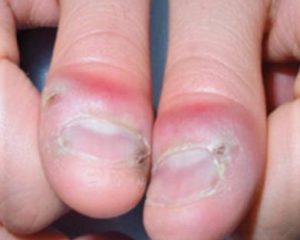 Surgical Treatment cured by Homeopathy medicine